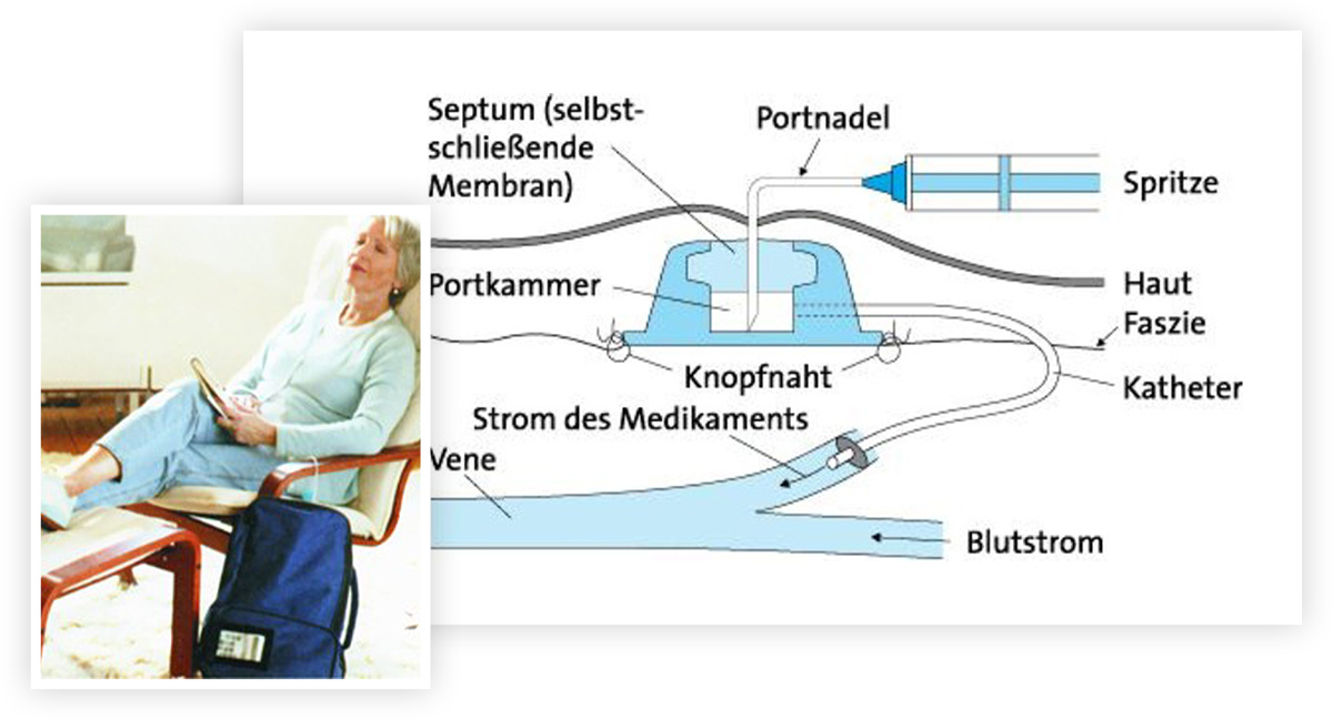 SPT Service für Parenterale Therapien | Wilhelmshaven - Der Portkatheter